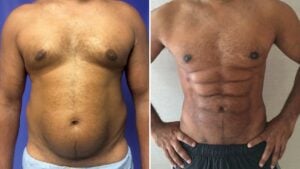 Skip the Gym, Plastic Surgeons Can Now Sculpt Belly Fat Into a Weird ...