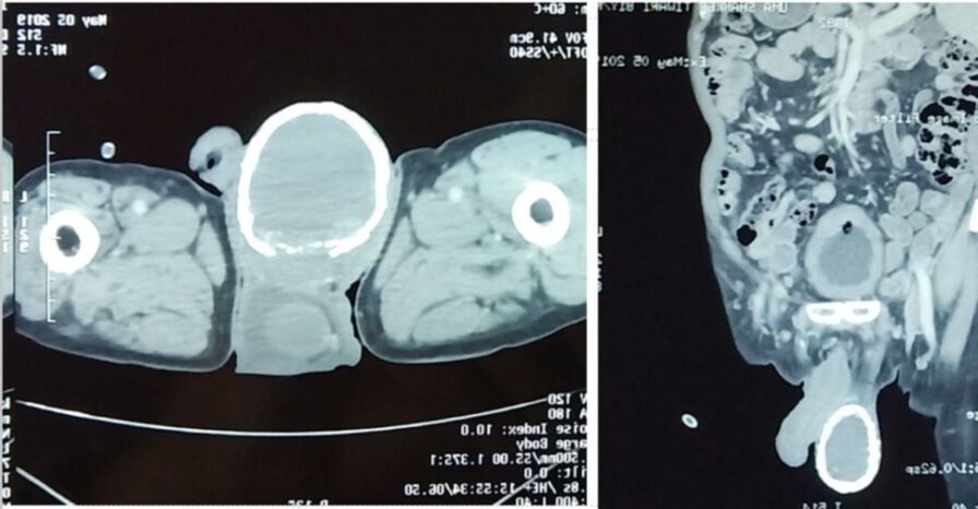 A Man's Worm Infection Left Him with a 'Stony Hard' Testicle