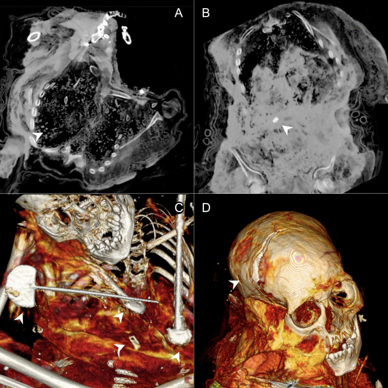 CT Scans Reveal Gruesome Details of Inca Child Sacrifices